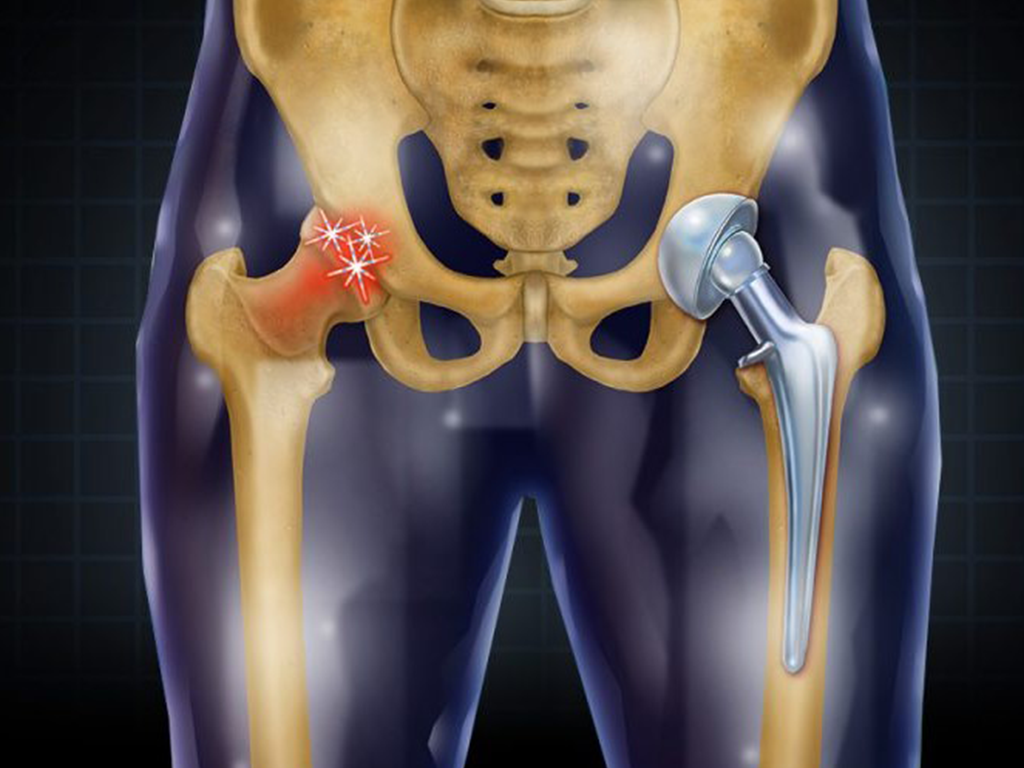 Best Hip Replacement Surgeon In Pune